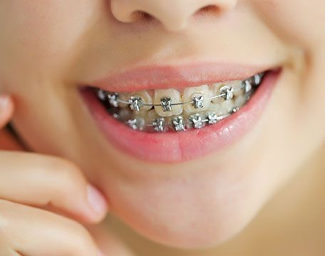 Vaste beugel – OrthoSmileHolten – Holten