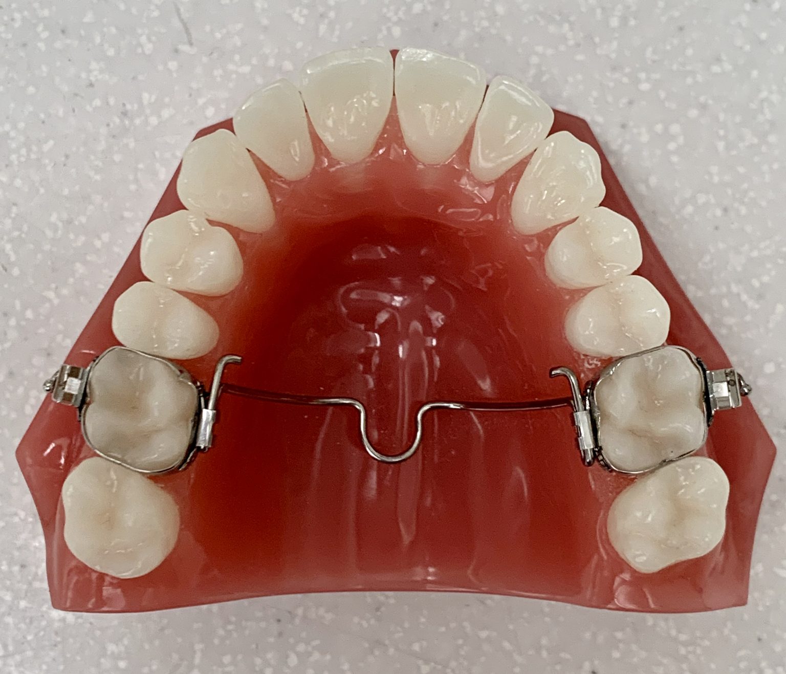 Spinbeugel of Hyraxbeugel – OrthoSmileHolten – Holten
