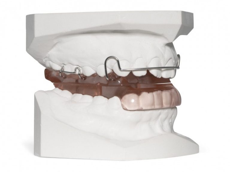 De Blokbeugel of Activator – OrthoSmileHolten – Holten